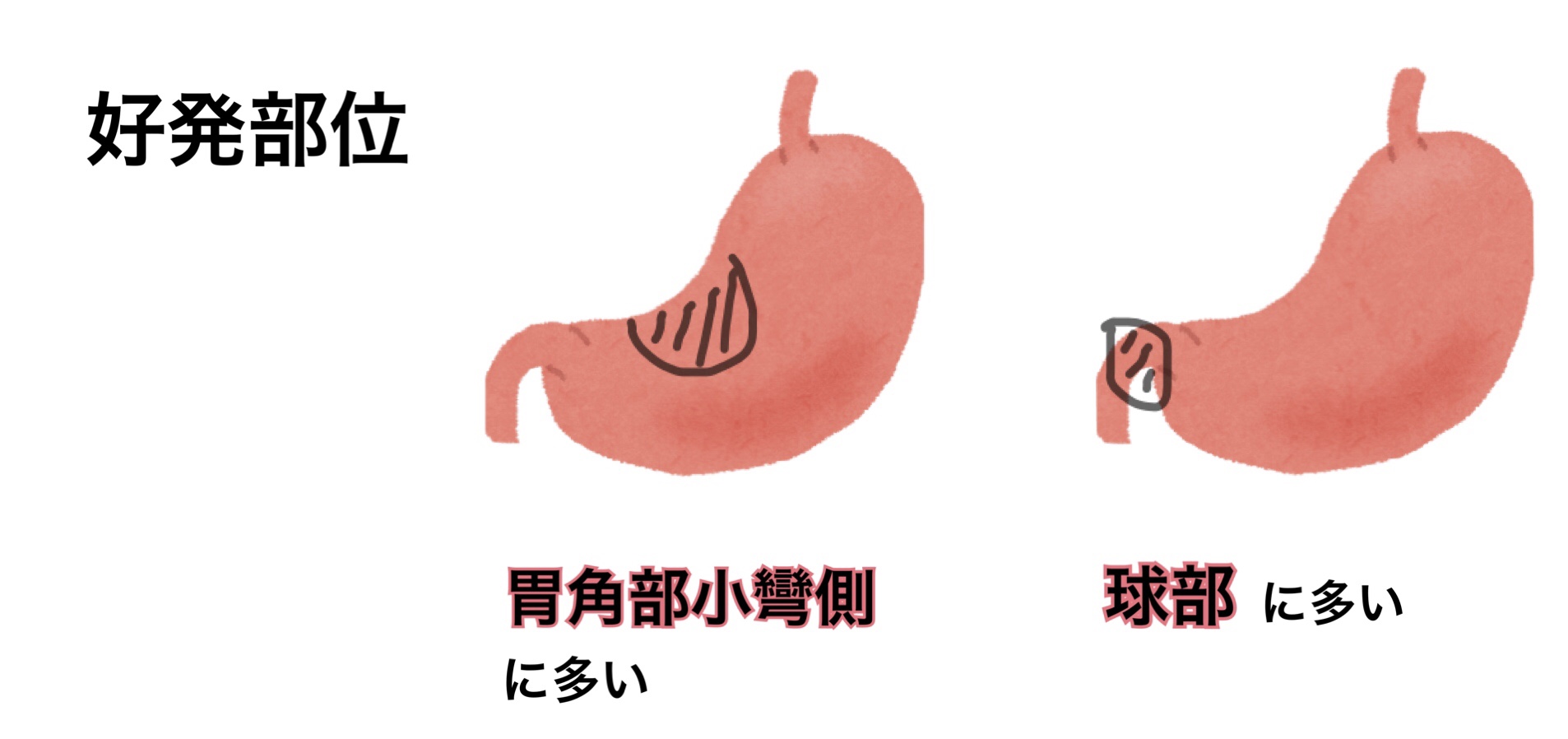 胃・十二指腸潰瘍の治療 ハシ 看護師国家試験対策アドバイザー